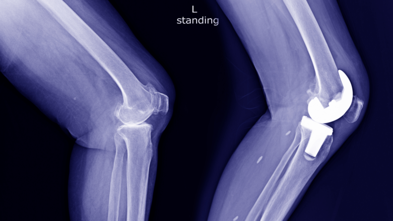 A Detailed Manual on Total Knee Replacement Surgery - Santokh Hospital